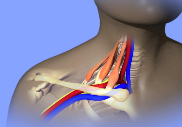 TOS-oireyhtymä voi aiheuttaa muun muassa käsien puutuneisuutta - Moverest